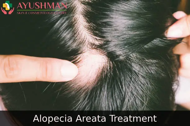Alopecia Areata Treatment in Dwarka, Delhi